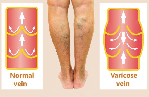 What do varicose veins look like?